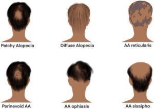 Alopecia: A 2-Minute Insight into Genetic Secrets - DrOmics Labs