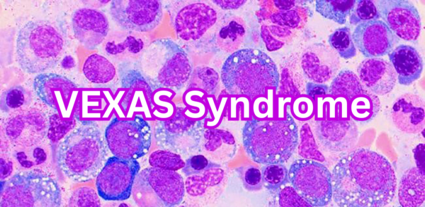 VEXAS Syndrome: A Rare Autoimmune Enigma - Prevention, Causes ...